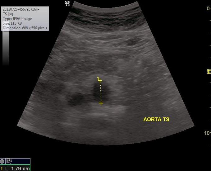 AAA screening scan - United Lincolnshire Hospitals